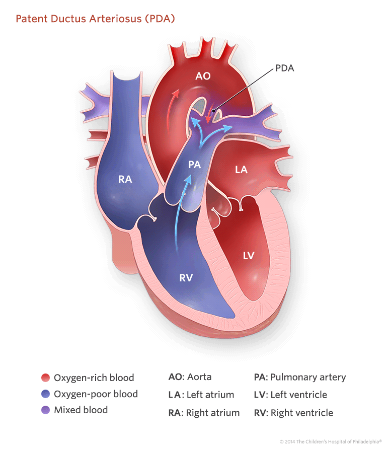 Patent Ductus Arteriosus (PDA) | Children's Hospital of Philadelphia Patent Ductus Arteriosus (PDA) | Children's Hospital of Philadelphia