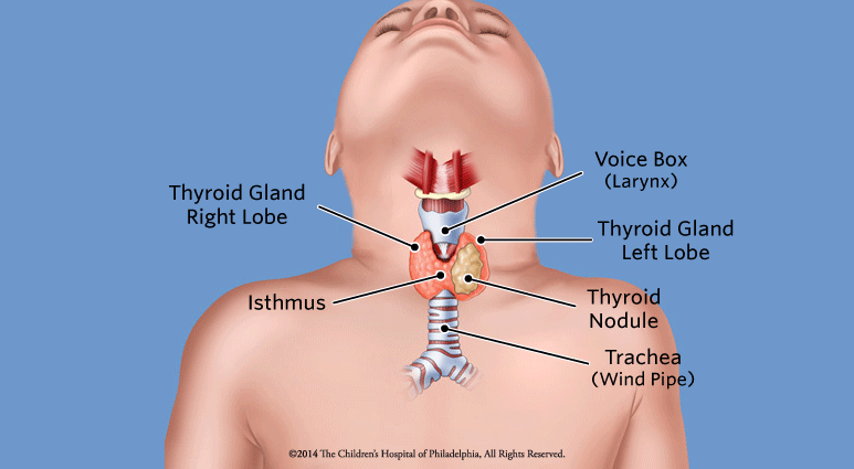 Thyroid Nodules | Children's Hospital of Philadelphia Thyroid Nodules | Children's Hospital of Philadelphia